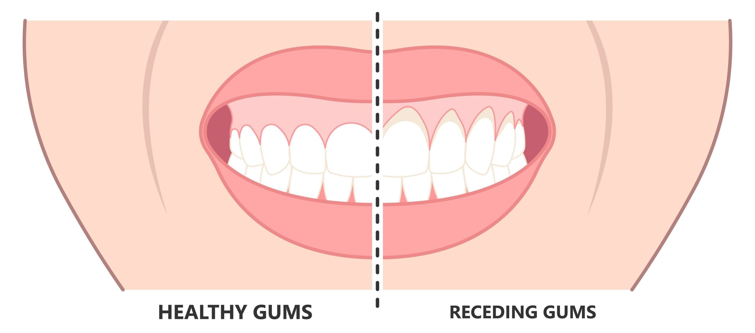 Cât de mult se pot retrage gingiile înainte ca dinții să cadă? - Oclea